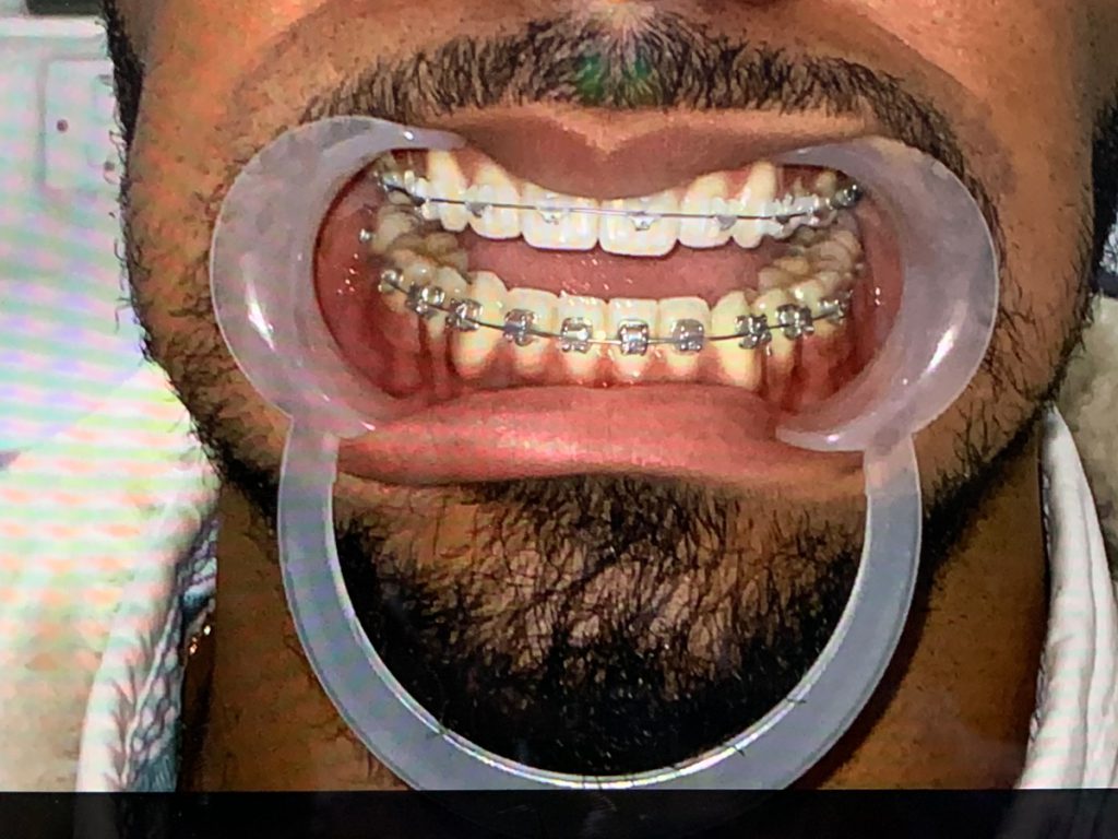 We're using Vision! | Queens Gate Orthodontics