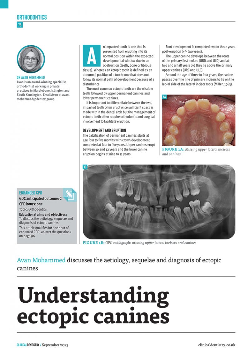 Understanding Ectopic Canines | Queens Gate Orthodontics
